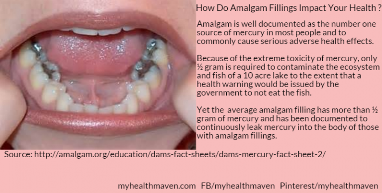 How Do Amalgam Fillings Impact Your Health – My Health Maven
