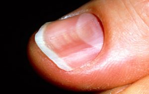 Learn What These 12 Nail Conditions Can Tell You About Your Health – My ...
